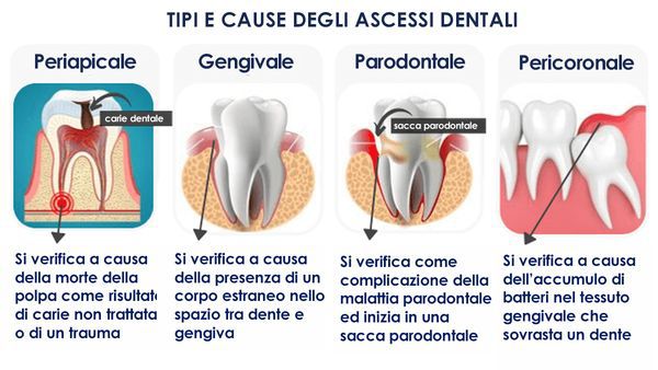ascesso dentale